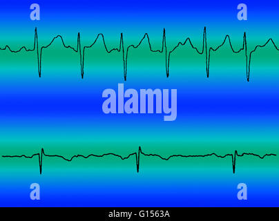 ECG EKG Pathology Stock Vector Art & Illustration, Vector Image ...