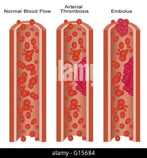 ARTERIAL THROMBOSIS, DRAWING Stock Photo - Alamy