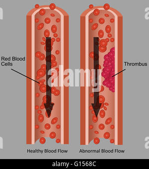 Illustrations showing healthy blood flow and abnormal blood flow (blood ...