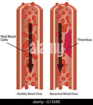 Illustrations showing healthy blood flow and abnormal blood flow (blood ...