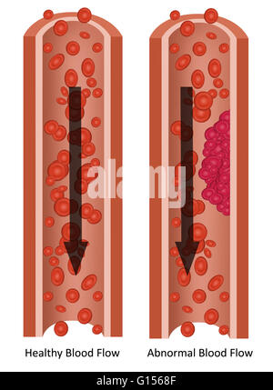 Illustrations showing healthy blood flow and abnormal blood flow (blood ...