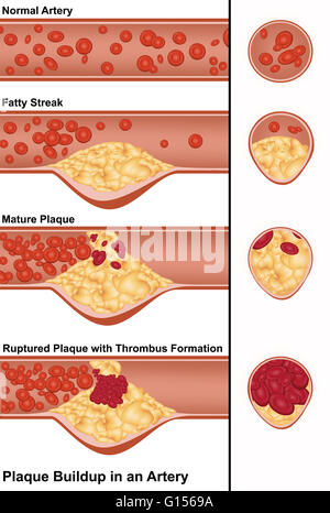 Diagram showing plaque build-up within an artery. From top to bottom ...
