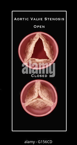 Illustration of aortic valve stenosis, a type of valvular heart disease characterized by an ...