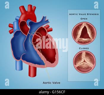 Illustration of aortic valve stenosis, a type of valvular heart disease ...