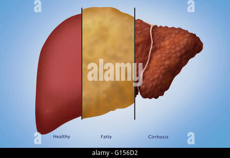 Illustration comparing the appearance a healthy liver (left) with its ...