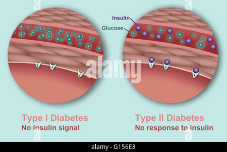 Illustration comparing Type I Diabetes (left) where the body fails to ...