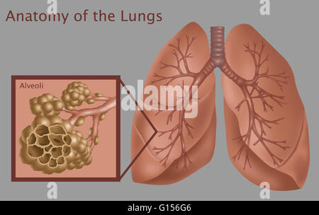 Illustration depicting alveoli with emphysema. The disease is most ...