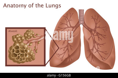 Illustration depicting alveoli with emphysema. The disease is most ...