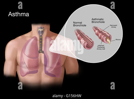 Asthma Pathology. An illustration of lungs with a normal airway Stock ...