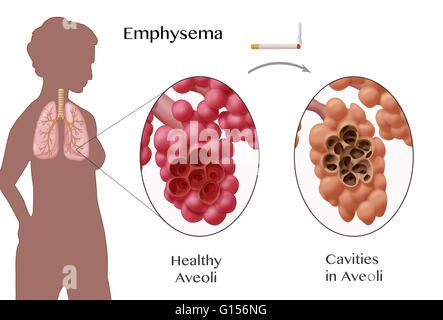 Illustration depicting emphysema, a condition characterized by damage ...