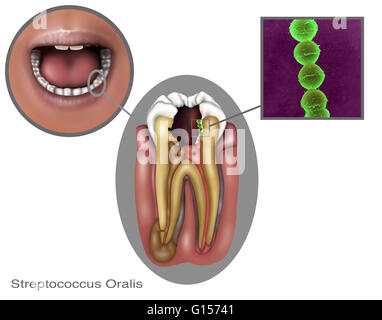 Illustration of an oral infection caused by the bacteria Streptococcus ...