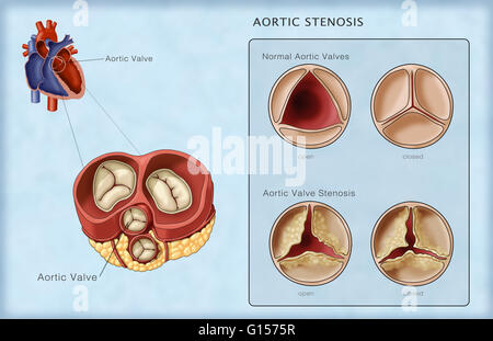 Illustration of normal aortic valves compared to an aortic valve stenosis Stock Photo - Alamy
