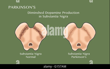 Illustration showing degeneration of dopaminergic neurons in the ...