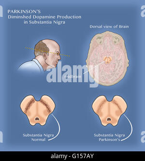 Illustration showing degeneration of dopaminergic neurons in the ...