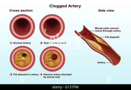 atherosclerosis coronary disease with plaque build up in the arteries ...