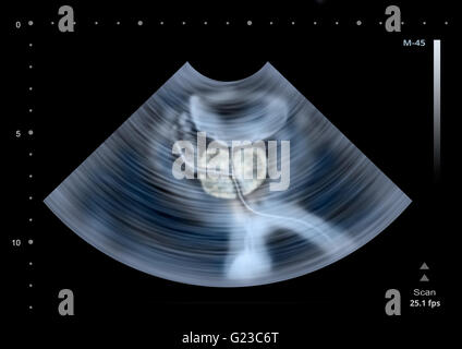 Medical X-Ray Scan - Prostate Stock Photo - Alamy