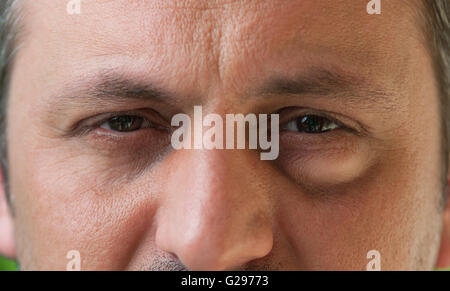 Eyesore, inflammation or bag swelling under eye. Medical problem like ...