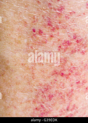 Red rash from combining sunbathing and medication. Allergy, sensitivity ...