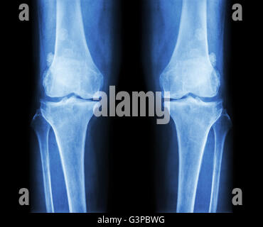 Osteoarthritis knee . film x-ray knee ( anterior - posterior and ...