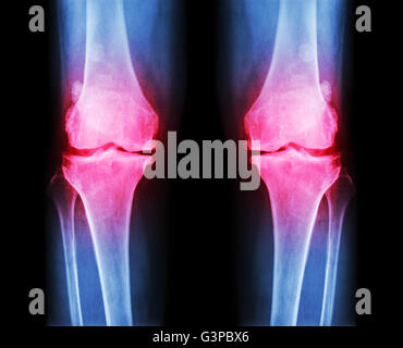 Osteoarthritis knee . film x-ray knee ( anterior - posterior and ...