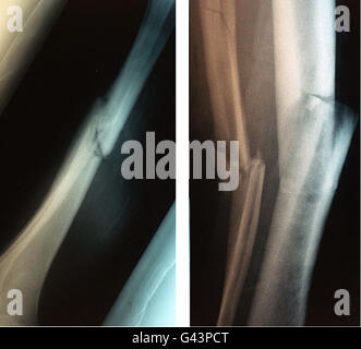 Dave Busst Leg Injury Stock Photo - Alamy