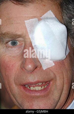 Prince Charles Eye Patch Stock Photo - Alamy