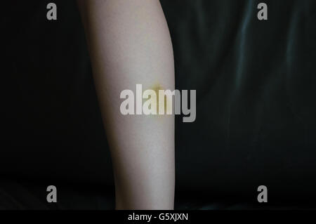 Girl with grazed leg Stock Photo - Alamy