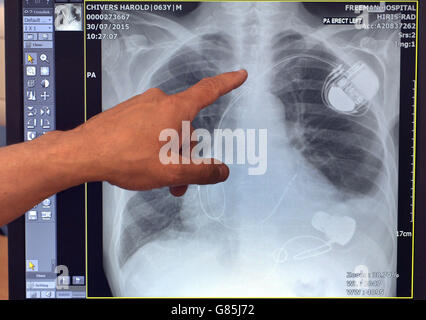 Patient has pioneering heart pump implant Stock Photo - Alamy