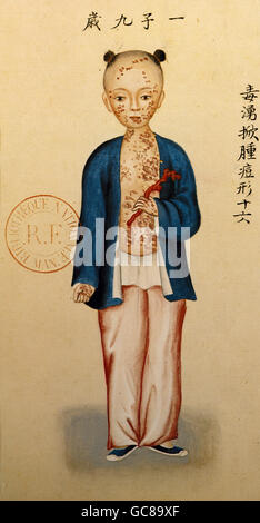 Smallpox, 18th century illustration Stock Photo - Alamy