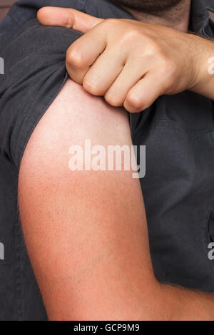 Sunburn on male hand. Trace from the shirt Stock Photo - Alamy