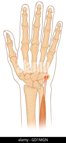 Illustration of the extensor carpi ulnaris muscle Stock Photo - Alamy