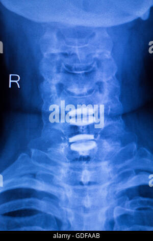 Spine, back and neck orthopedic titanium metal spinal plate brace and ...