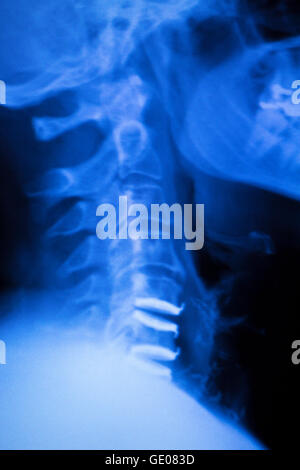 Spine, back and neck orthopedic titanium metal spinal plate and screw ...