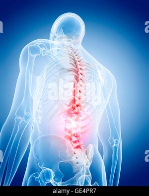 Human back pain, illustration Stock Photo - Alamy