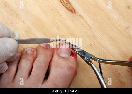 Surgery on a broken bleeding toe nail a man Stock Photo - Alamy
