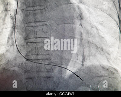VVIR pacemaker in x-ray image in cardiac catheterization laboratory ...