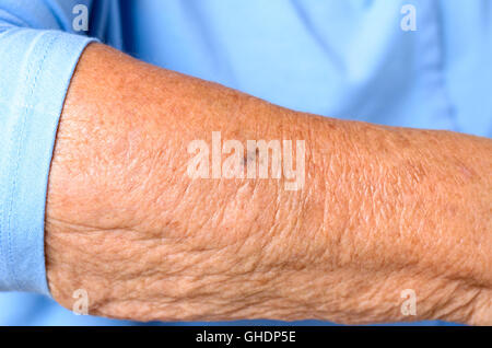 AGE SPOTS spot skin old problem cancer spotted close up closeup makro ...