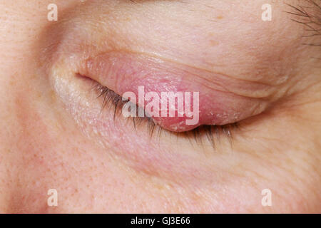 Chalazion in upper eyelid. A chalazion, also known as a meibomian gland ...