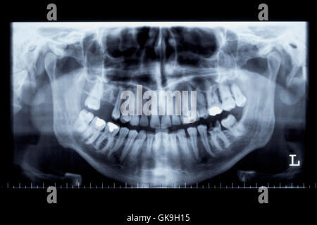 Human jaw with teeth implants anatomy model isolated on blue background ...