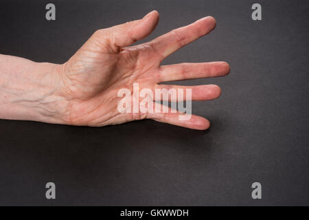 Dupuytren's Contracture or Syndrome of the ring finger of the left hand ...