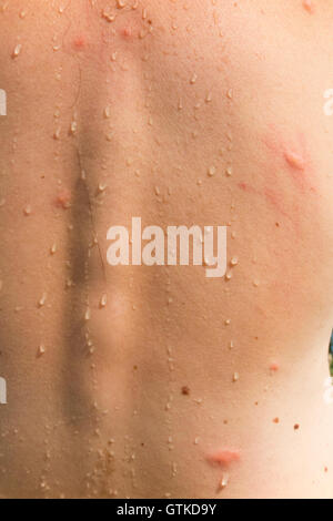 Tourist swimmer at Lac Du Bourget France with inflammation thought ...