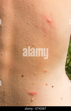 Tourist swimmer at Lac Du Bourget France with inflammation thought ...