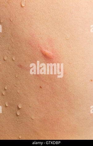 Tourist swimmer at Lac Du Bourget France with inflammation thought ...