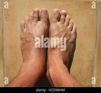 Broken ankle, mens feet Stock Photo: 144934096 - Alamy
