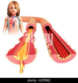 Illustration of child's infected bronchi Stock Photo - Alamy