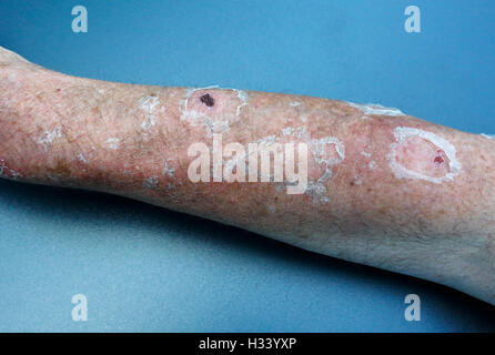 health, medicines, forearm skin damage, blistering and peeling skin ...