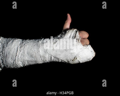 Broken hand in plaster cast with bandages, red, swollen fingers after ...