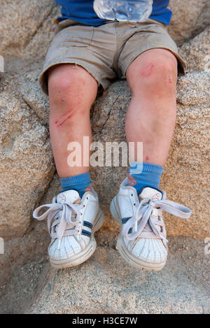 The knee is scratched. Close up on an bleeding scraped child his knee ...