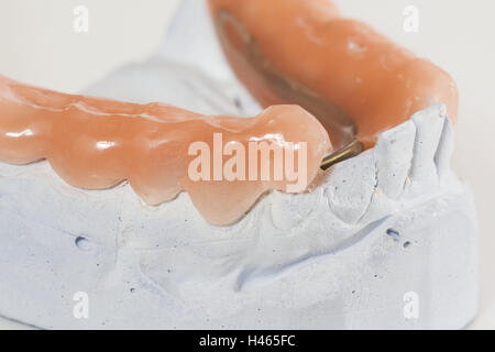 dental impression, adjusted bite splint, Michigan splint, medicine ...