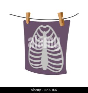 rib,cage,xray,body,spine,sternum,breastbone,calcium,surgery,bone ...